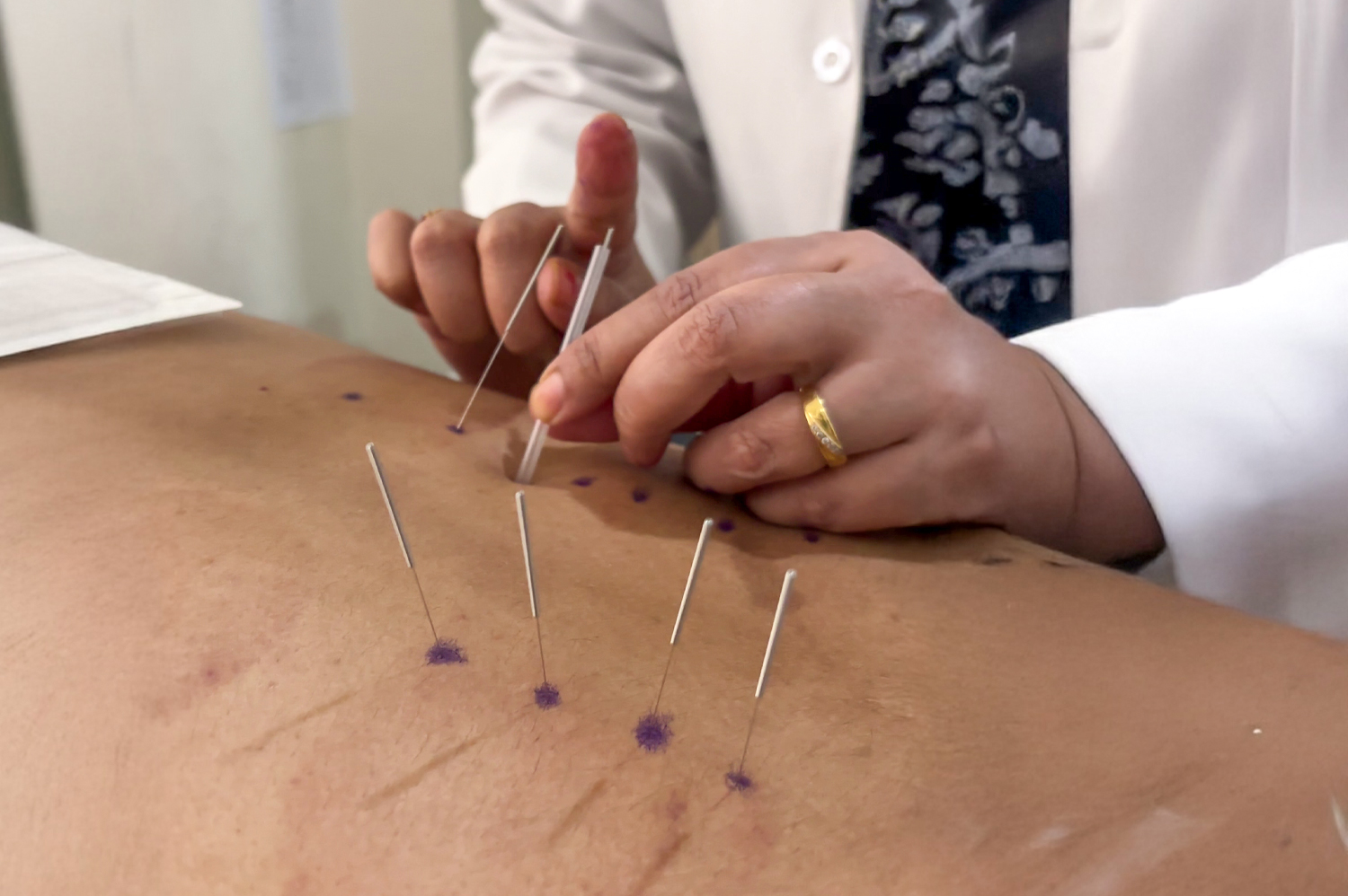 Dry Needling Physiotherapy in Kolkata | Pain Relief Experts